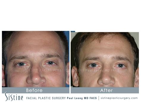 Nose Before And After Leong Facial Plastic Surgery