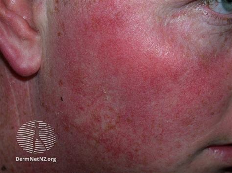 Actinic Keratoses Affecting The Face Dermnet Nz Lesions Ak Face Nc
