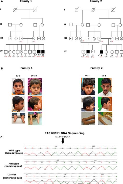 Mutated Rap1gds1 Causes A New Syndrome Of Dysmorphic Feature Intellectual Disability And Speech