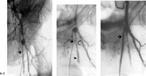 Atherosclerotic Disease Of The Aorta Pelvis And Lower Extremities