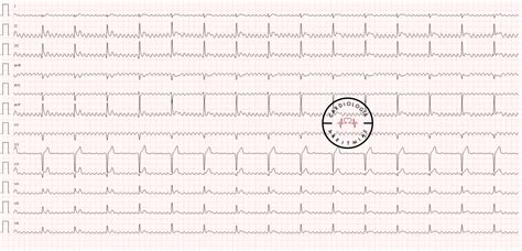 Flutter Auricular Ecg 2025