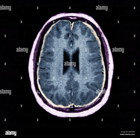 Bacterial Meningitis Coloured Magnetic Resonance Imaging Mri Scan Of An Axial Section Through