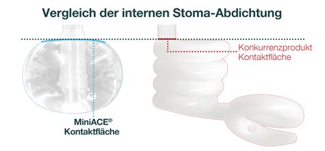 Miniace® Enema Button Applied Medical Tech