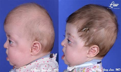 Craniosynostosis Before And After Photos Law Plastic Surgery