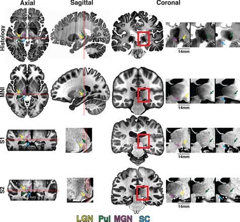 anatomical localization of human subcortical structures the anatomical