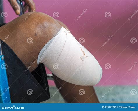 Elastic Bandaged Below Knee Amputation Stock Image Image Of Care