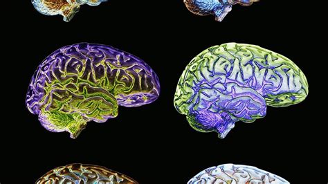 Dr Dulas Work On Restarting Anticoagulation After Stroke Published In