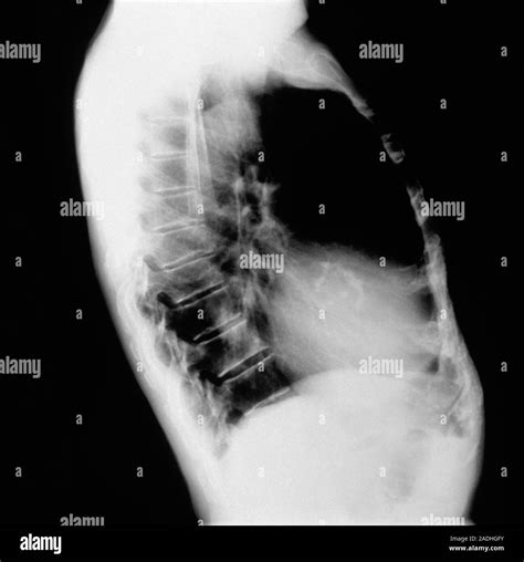 Lateral X Ray Of The Chest Area Of A Person With Calcified Aortic