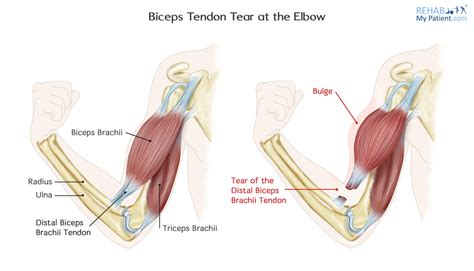Biceps Tendon Tear At The Elbow Rehab My Patient