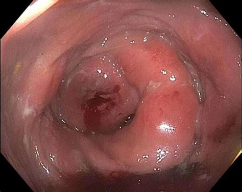 Syphilitic Proctitis Presenting As Locally Advanced Rectal Cancer A