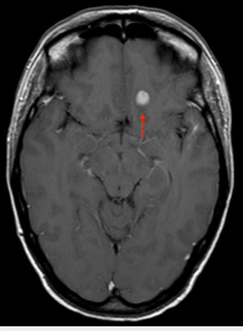 Axial T1 Weighted Mri Contrast Scan Highlighting A Solitary Meningioma