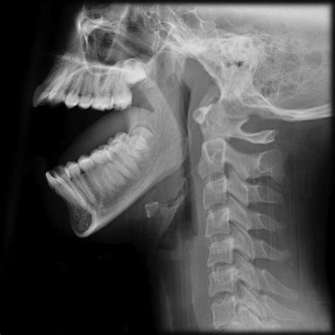Tmj Dislocation Buyxraysonline