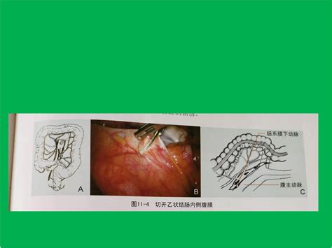 腹腔镜结肠癌根治术 手术过程 知乎