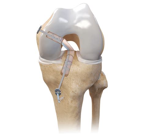 Arthrex Posterior Cruciate Ligament Pcl Reconstruction