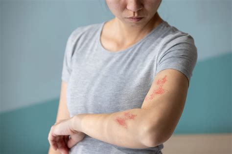 Hives Causes Symptoms Diagnosis Treatment And Prevention · Theanswerguide