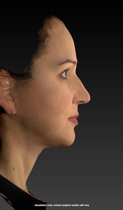 Facelift Before And After Photos Mary Lynn Moran Md