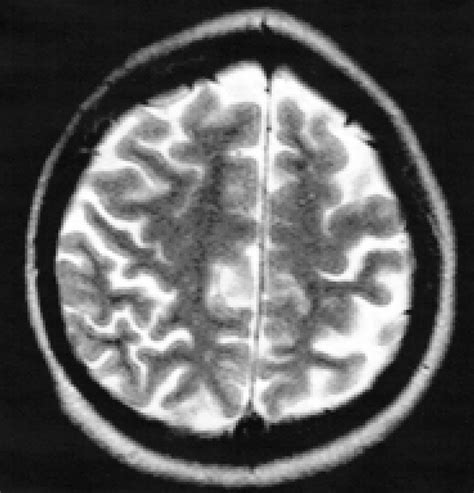 Axial Se T2 Image Diffuse Brain Atrophy Particularly Marked At The