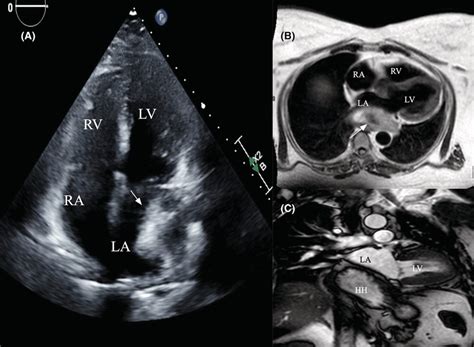 A Transthoracic Echocardiogram Showing An Echogenic Mass Arrow In