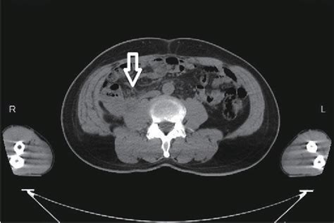 Figure 4 From Squamous Cell Carcinoma Of The Renal Pelvis—a Rare Case