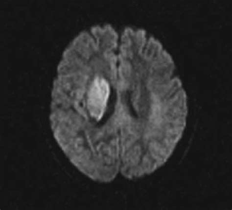 Basal Ganglia Ischemic Stroke At Caitlyn Tooth Blog