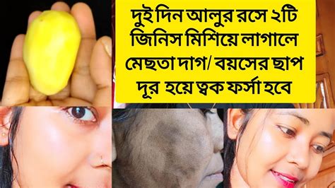 আলুর রসে এই দুটি জিনিস মিশিয়ে লাগালে ত্বক ফর্সা হবে মেছতার দাগ দূর হবে