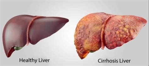 Why Do People Get Liver Cirrhosis By Dr Aditi Bakshi Jul 2024