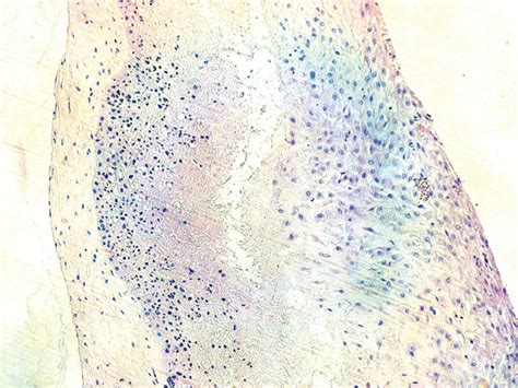Membrane Inflammatory Infiltrate Rich In Lymphocytes Hematoxylin Eosin