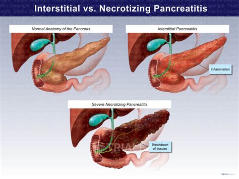 Interstitial Vs Necrotizing Pancreatitis Trialquest Inc