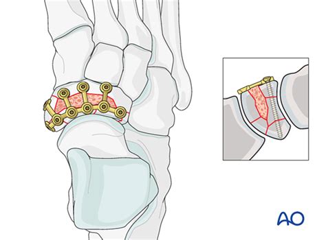 Orif Navicular Plate For Complete Articular Navicular Fracture