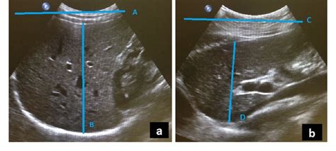 Liver Measurement Ultrasound Pancreas And Its Proportions Hot Sex Picture