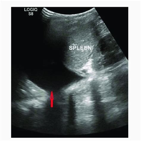 Ultrasound Chest Suggesting Pleural Effusion Right Side Download