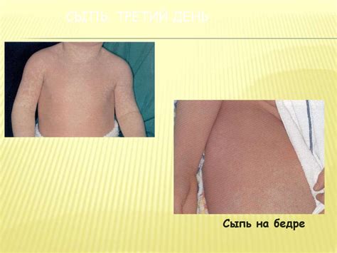 Корь презентация онлайн