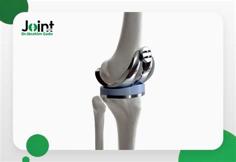 تغيير مفصل الركبة Joint Clinic