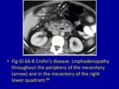 66 Mesenteric Lymph Node Enlargement