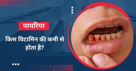 पायरिया रोग किस विटामिन की कमी से होता है ऐसे करें पूर्ति 100 लाभ