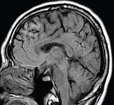 Fcm Algorithm Denoising Results Abcd Showed The Patients Head Mri Download Scientific Diagram