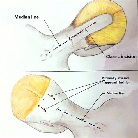 Comparison Of Incision Classic And Minimally Invasive Method
