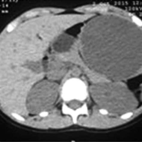 Ct Of The Abdomen Showing Splenic Cyst Of Hypodense Appearance