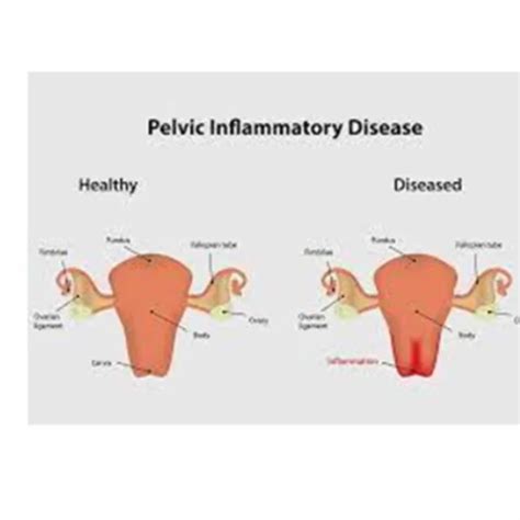 Pelvic Inflammatory Disease Treatment At ₹ 2500pack In Noida Id