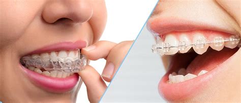 Braces Vs Invisalign Which One Is Better