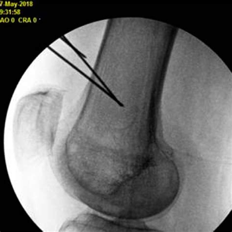 Genicular Nerve Rfa Probe Targets On Anteriorposterior Fluoroscopic