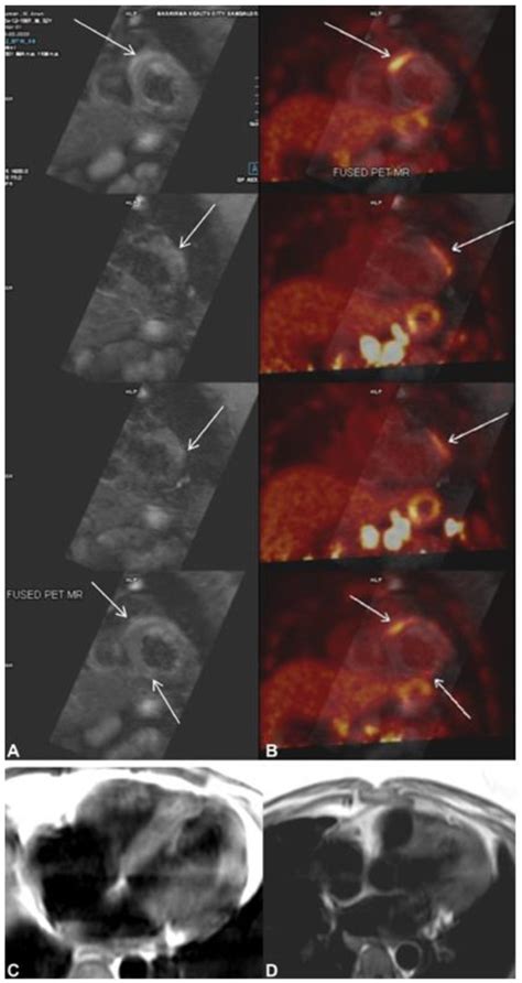 Tuberculosis Of The Heart A Diagnostic Challenge Pmc