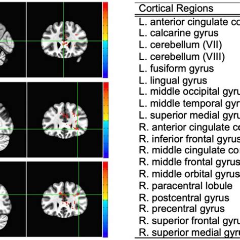 Blood Oxygen Level Dependent Bold Signal Group Analysis At Baseline