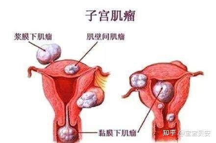 子宫肌瘤会癌变吗 知乎