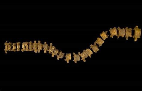 проф др Зафер Оркун Токташ От какво се причинява сколиозата