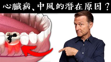 很少人知道心臟病、中風原因？吃脂質維生素c自然療法柏格醫生 Dr Berg Youtube