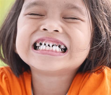 Black Teeth What Is It Causes Symptoms Stains And More