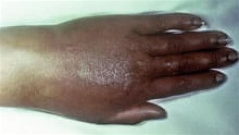 Resistant Gonorrhea Strain Found In Japan Cbc News