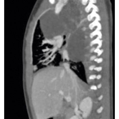 Magnetic Resonance Imaging Mri Insinuating Multiloculated Cystic