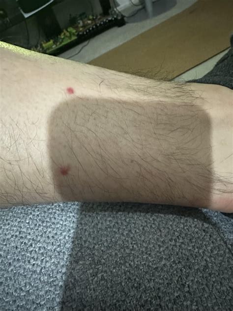 Bug Bite Info R Auckland